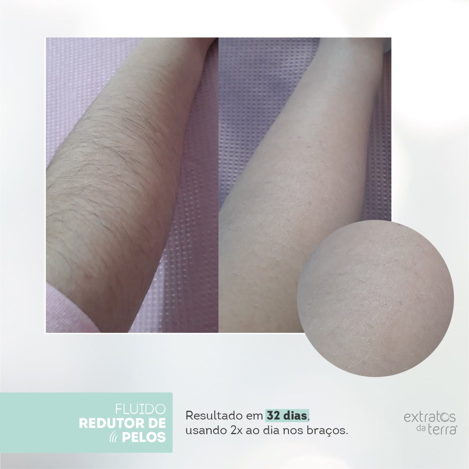 Inibidor de pelos ou redutores de pelos funcionam? - Blog - Extratos da ...
