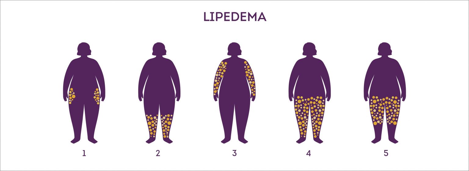 Lipedema e Linfedema: quais as diferenças